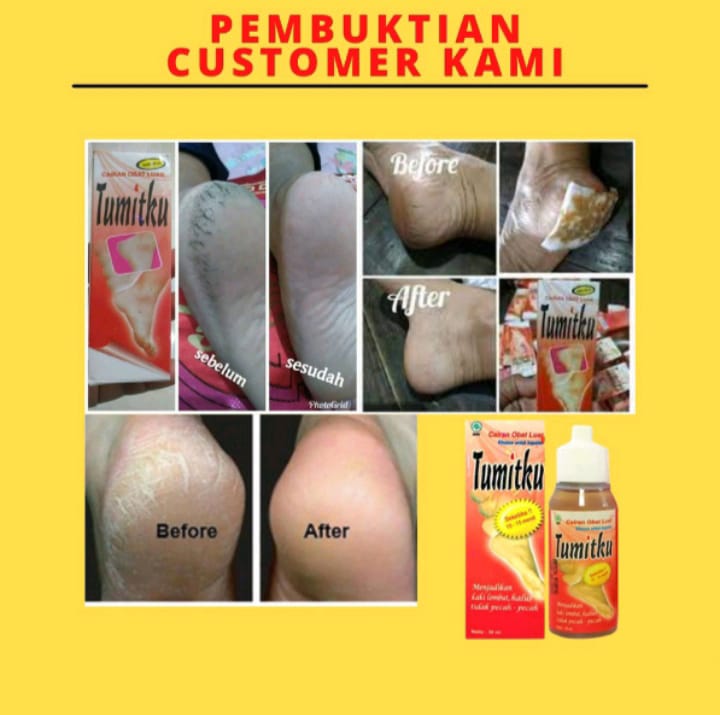 TUMITKU - SOLUTION OF CRUSHED / BROKEN FEET | Inaexport